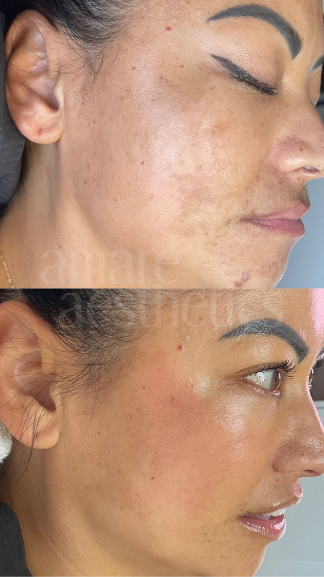 enlighten peel – amare aesthetics