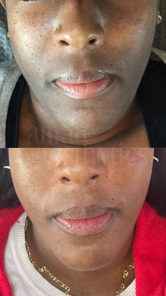 enlighten peel – amare aesthetics